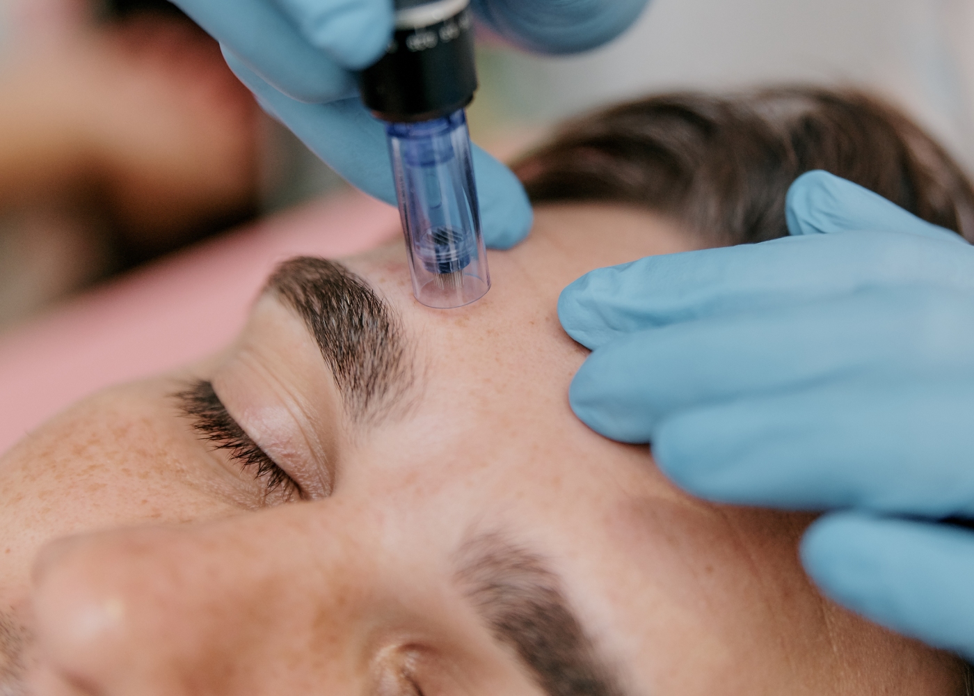 Microneedling In Singapore: 10 Aesthetic Clinics And Treatments